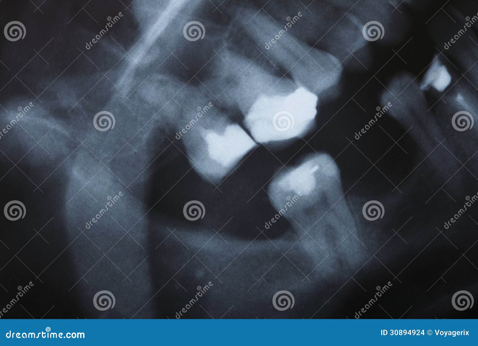 X-ray scan of humans teeth stock photo. Image of xray - 30894924