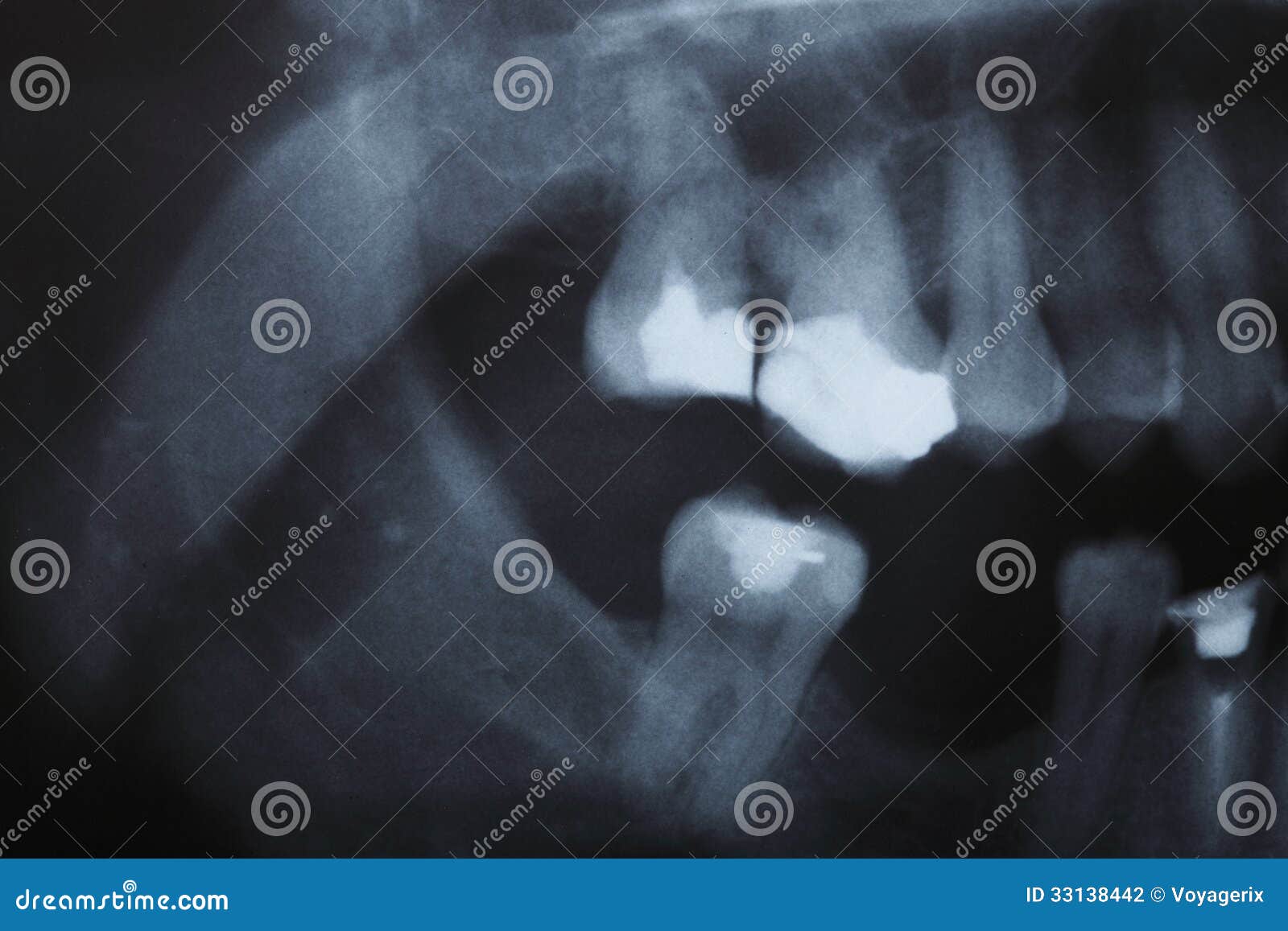 X-ray scan of humans teeth stock photo. Image of medicine - 33138442