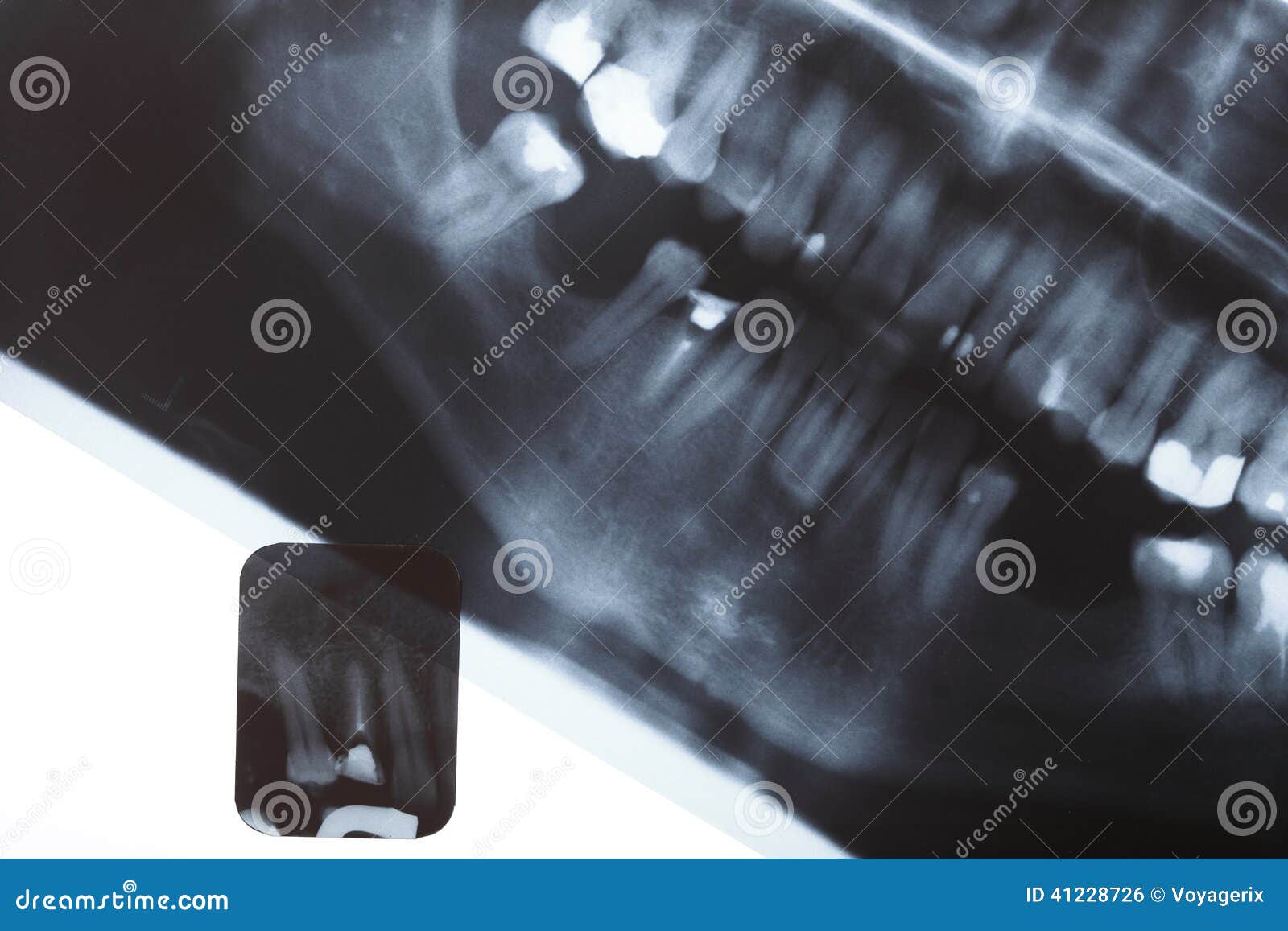 X-ray scan of humans teeth stock photo. Image of black - 41228726