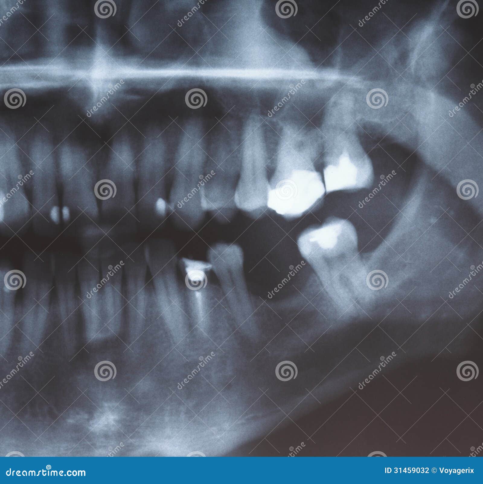 X-ray scan of humans teeth stock photo. Image of skeleton - 31459032