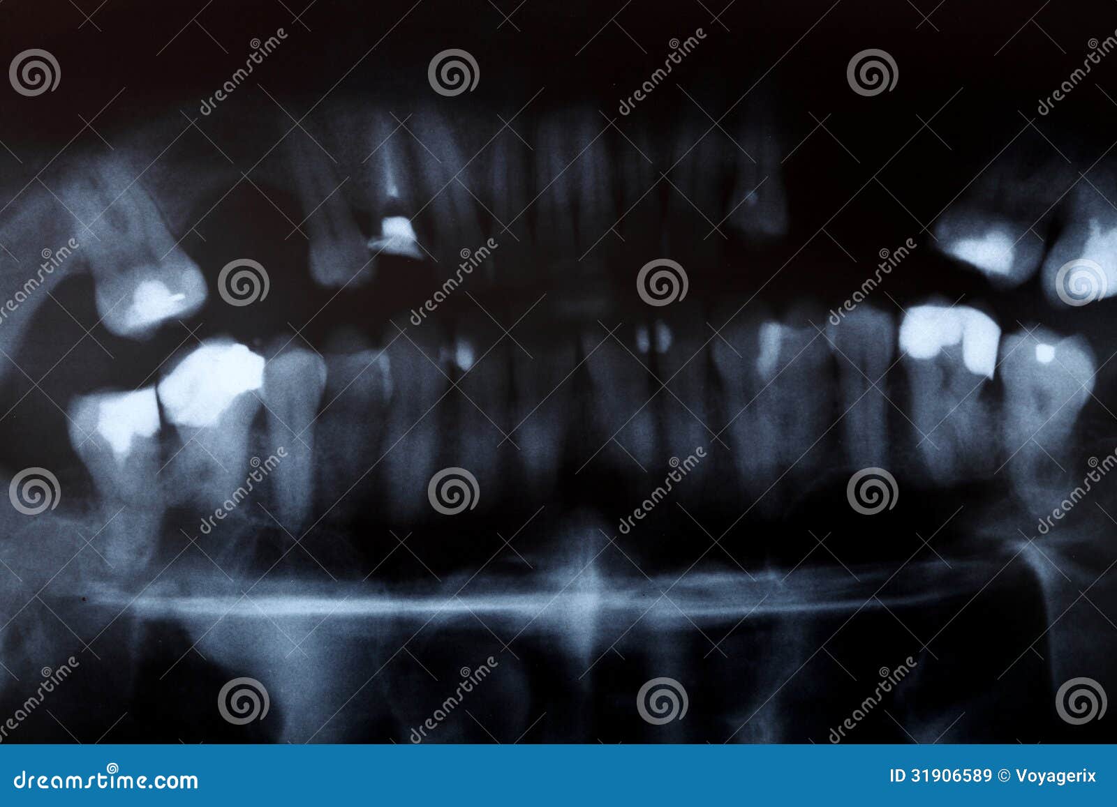 X-ray scan of humans teeth stock image. Image of bone - 31906589