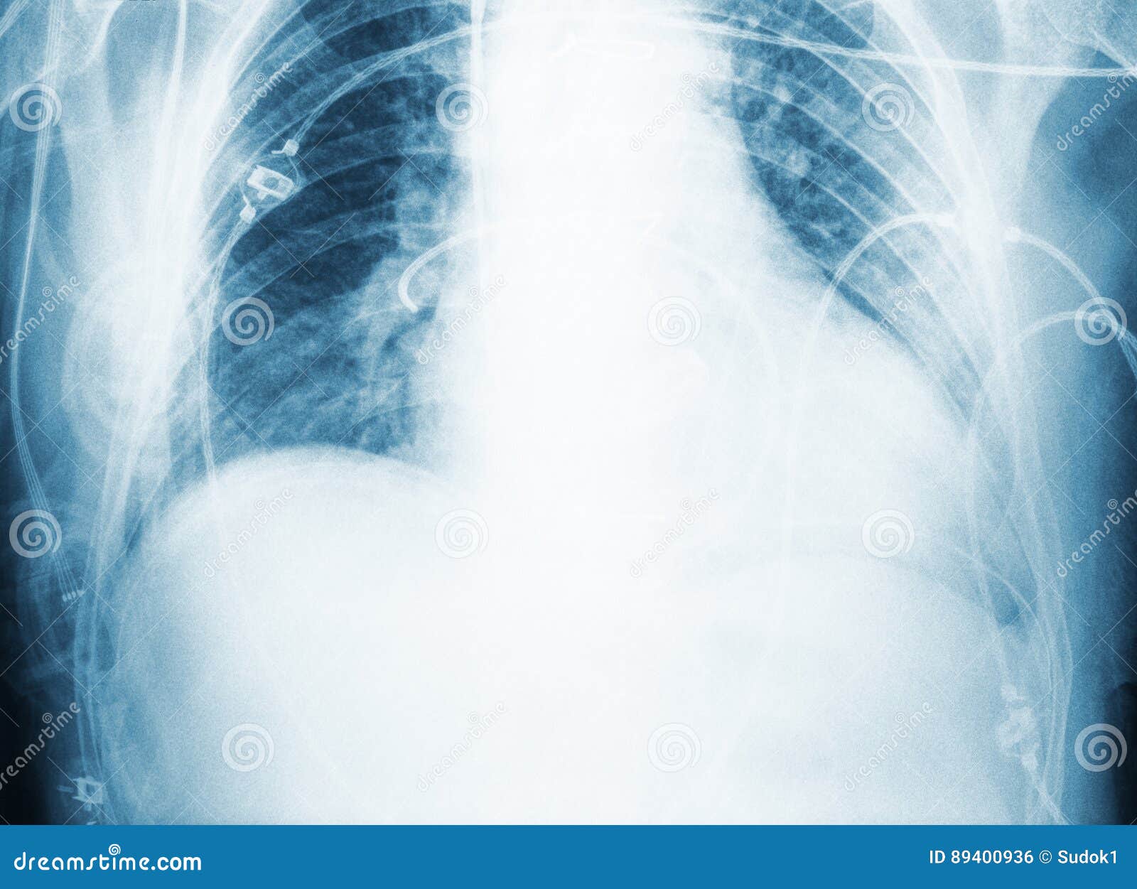 X-ray Scan of Patient`s Chest after Surgery Stock Photo - Image of exam ...