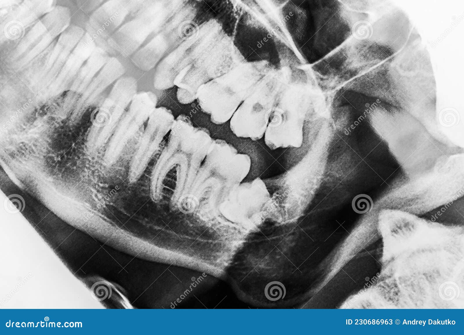 X-ray Scan Picture of Wisdom Teeth Dentistry Close-up Stock Image ...