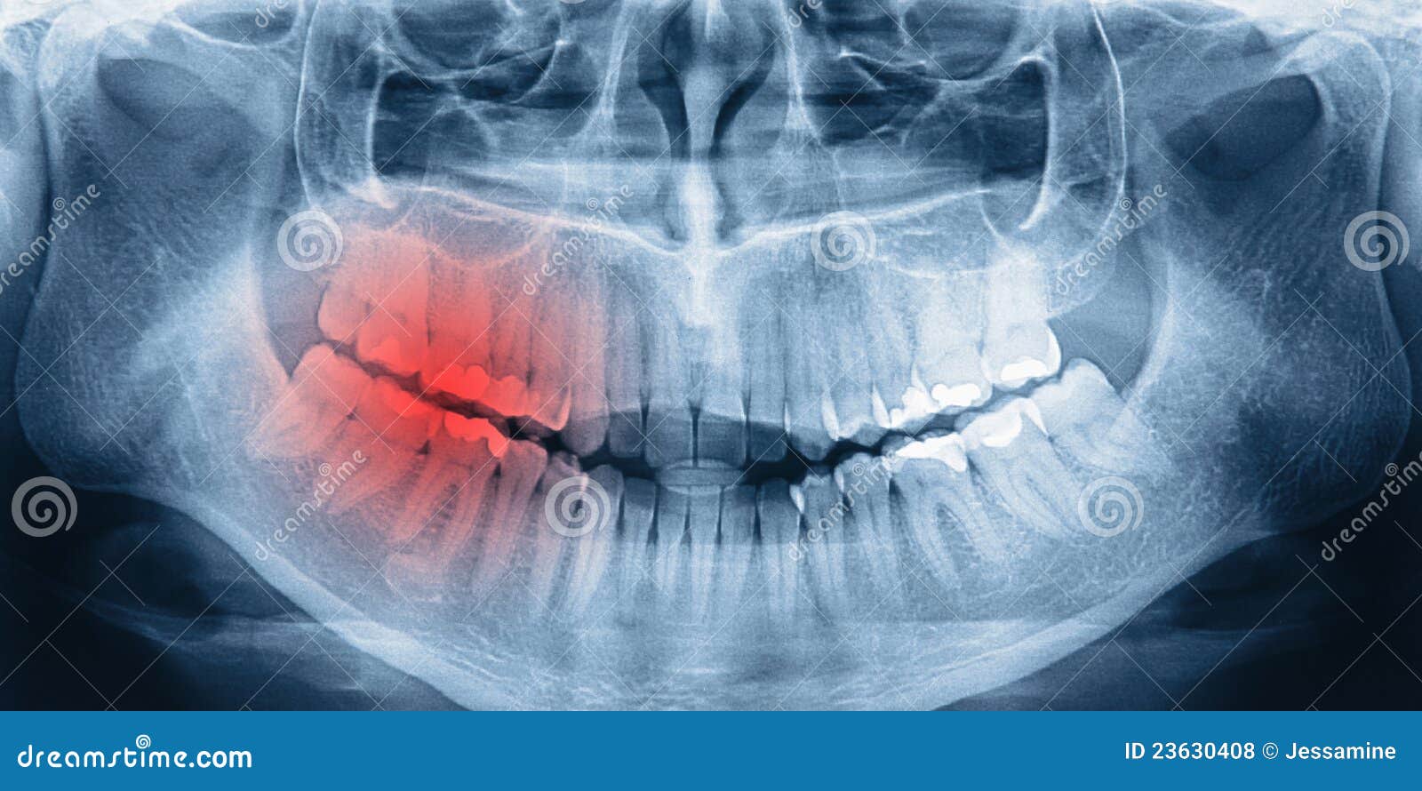 X-ray scan of teeth stock photo. Image of people, medicine - 23630408
