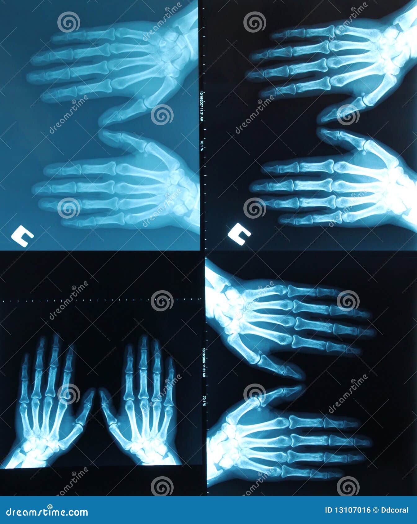 X-ray scanning stock photo. Image of illness, object - 13107016
