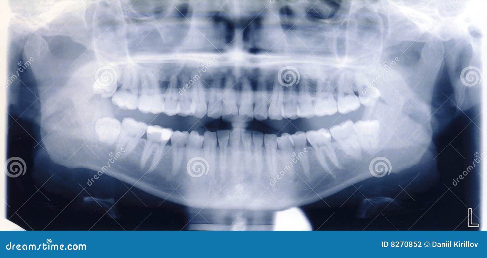 X-ray Shoot of Human Mouth and Teeth Stock Photo - Image of disease ...