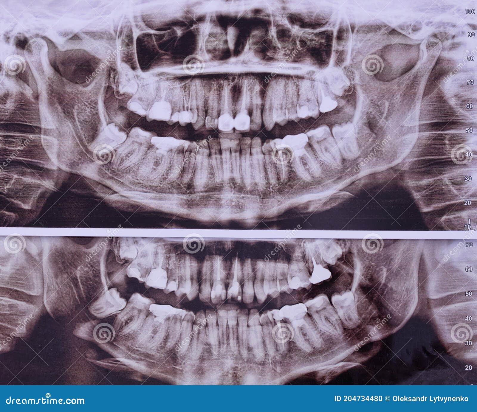 X-ray shot of teeth stock photo. Image of dental, mouth - 204734480