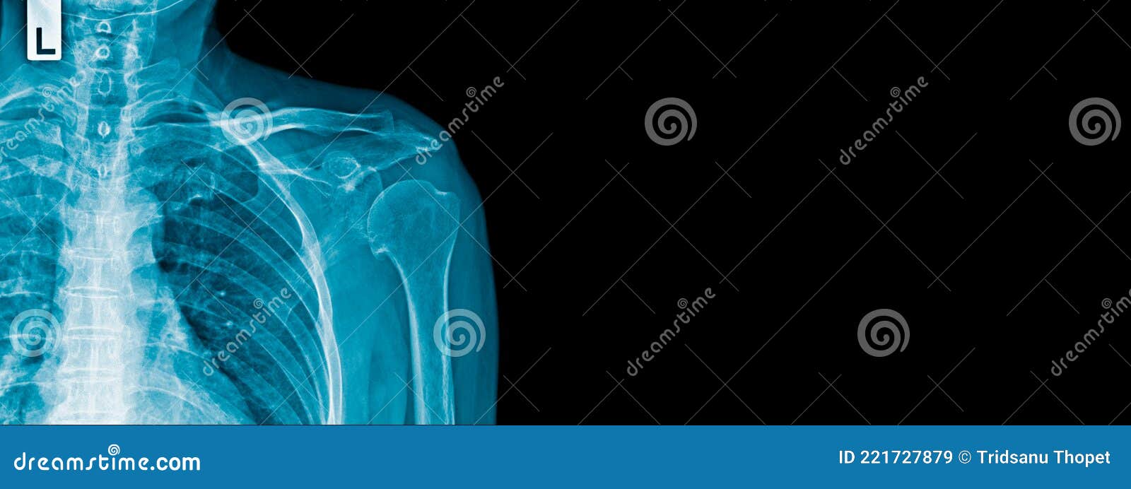 Shoulder X-ray Banner Royalty-Free Stock Photo | CartoonDealer.com ...