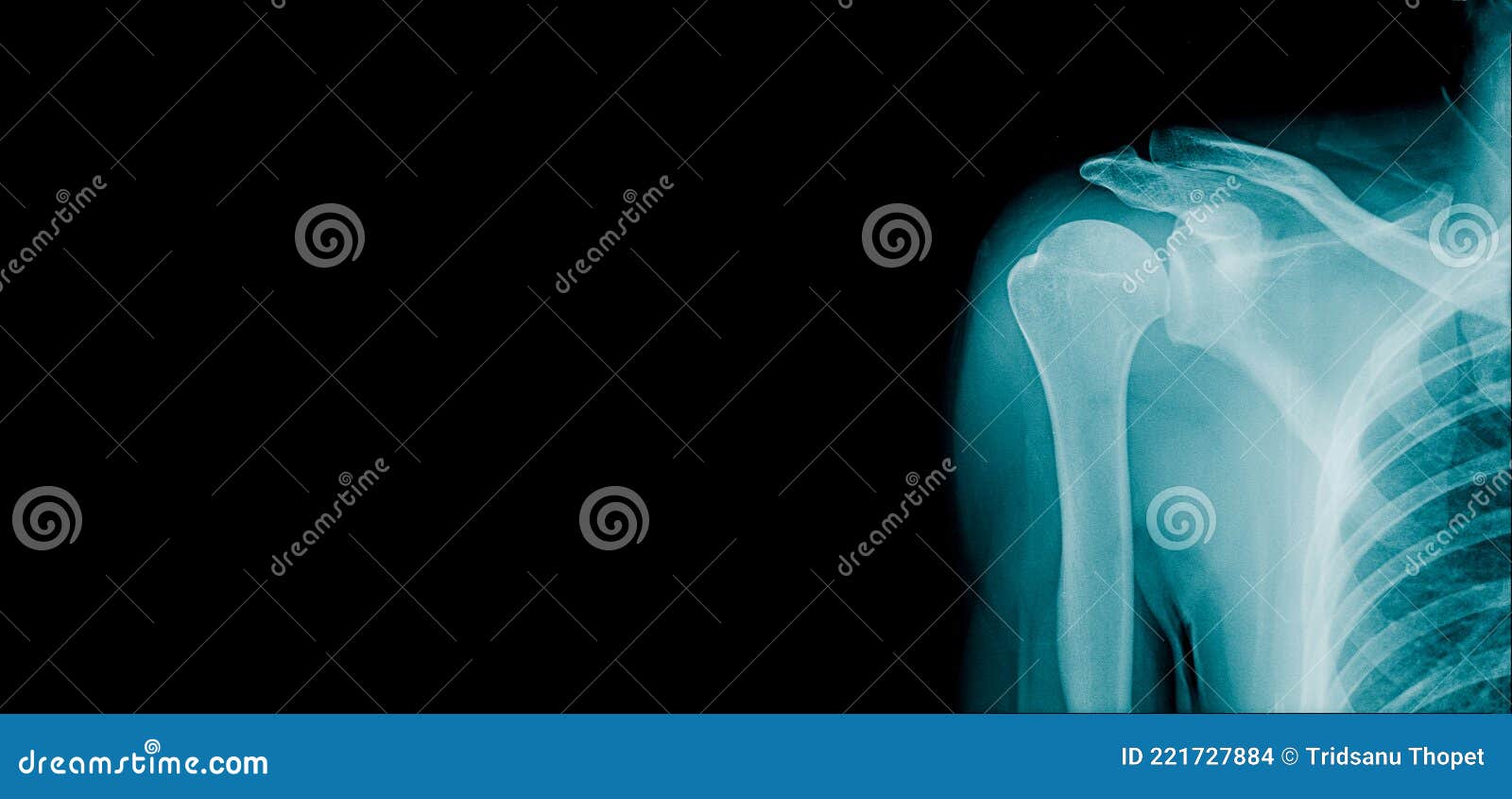 Shoulder X-ray Banner Royalty-Free Stock Photo | CartoonDealer.com ...