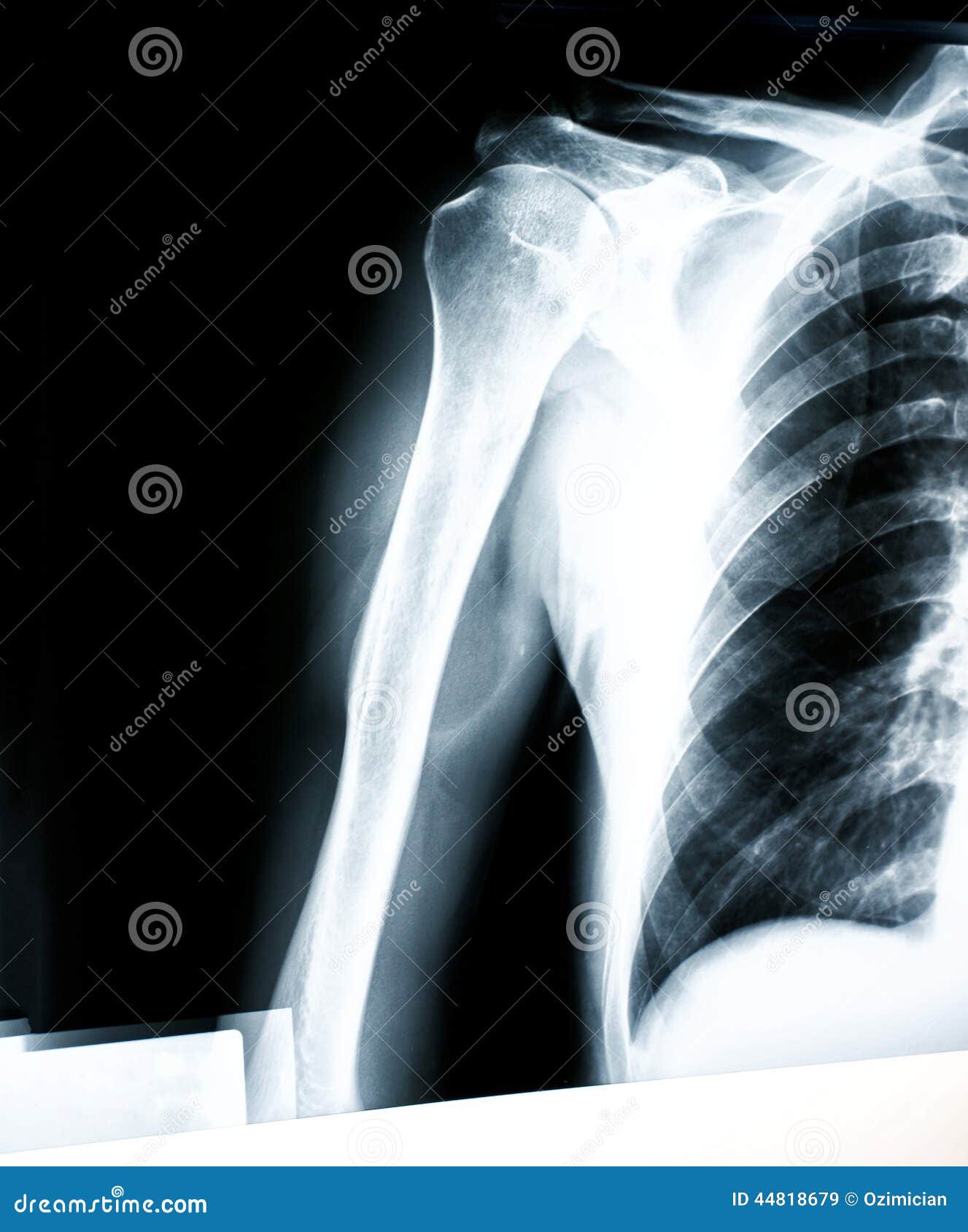 X-ray of shoulder stock image. Image of healthcare, humeral - 44818679