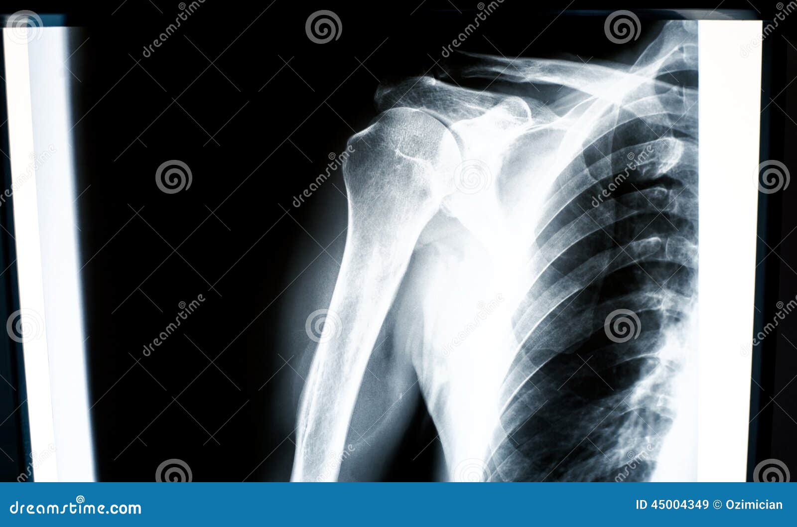 X-ray of shoulder stock image. Image of human, vision - 45004349