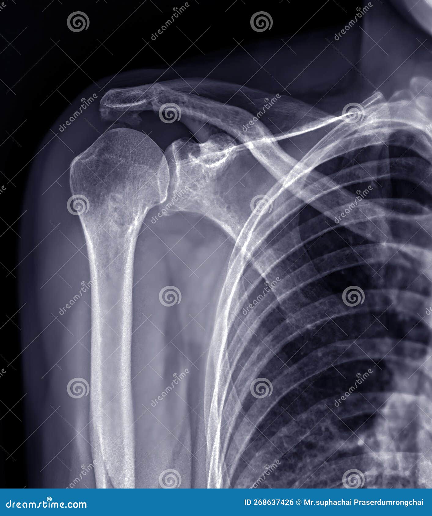 Fractured Humerus, Vintage Illustration Cartoon Vector | CartoonDealer ...