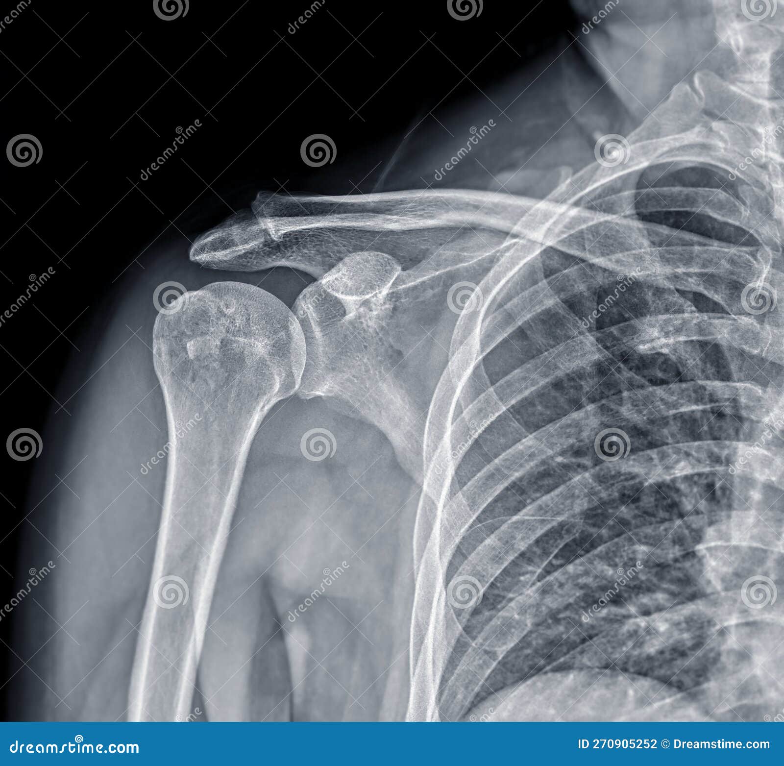 X Ray Shoulder Sharp Shoulder Pain, Getting Worse, After A Fall | The