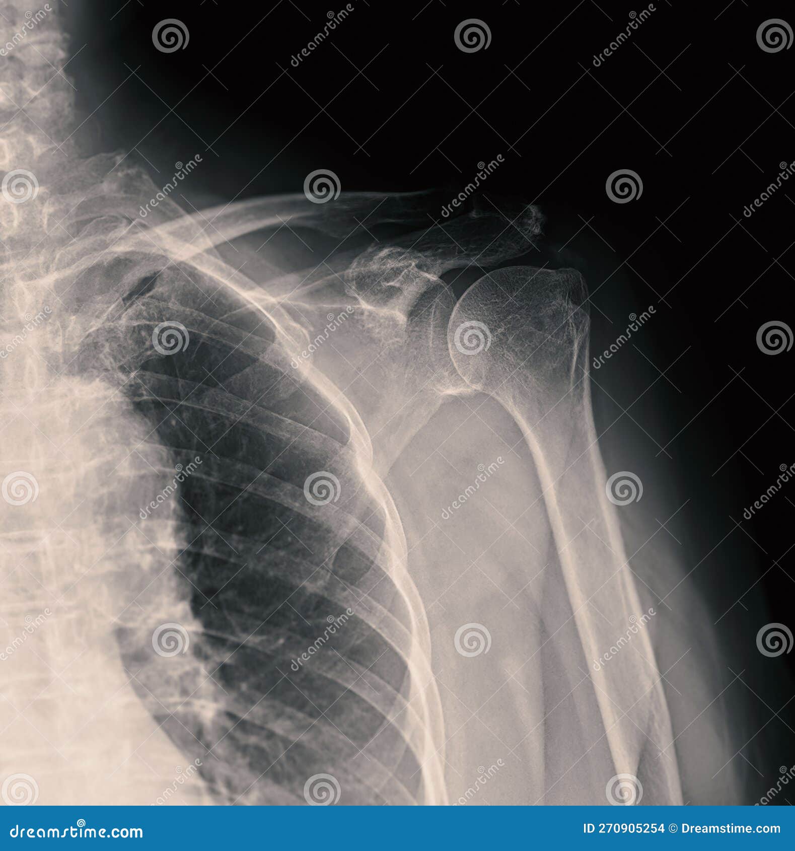 X-ray Shoulder Joint Shoulder Front View for Diagnosis Fracture of ...