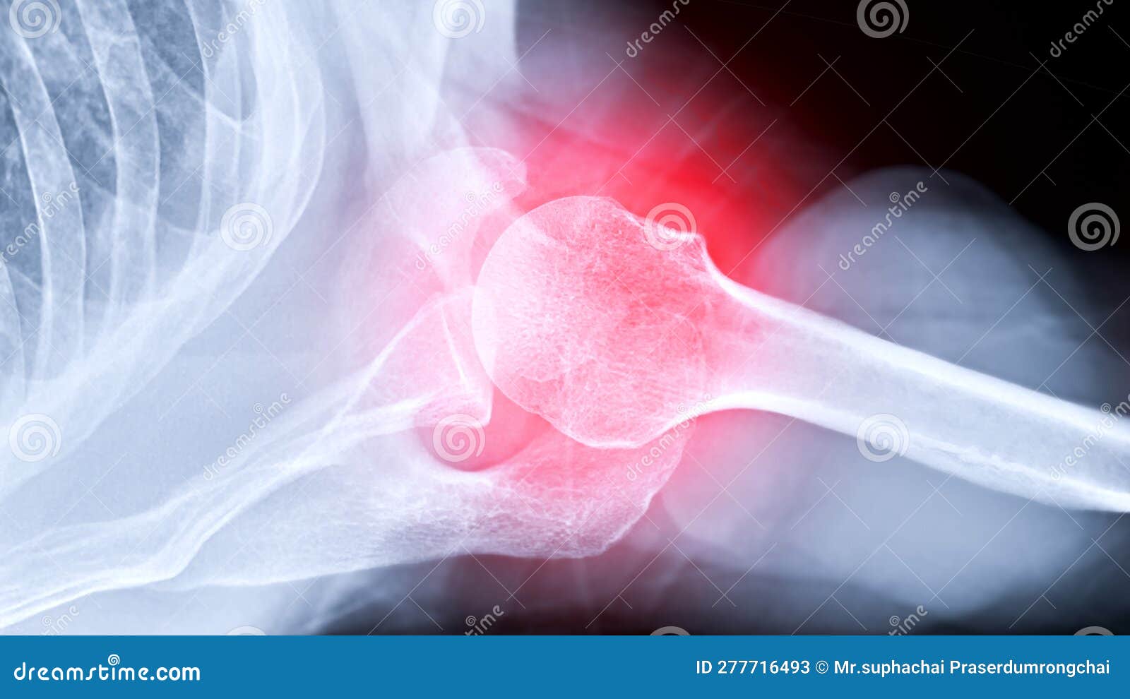 X-ray Shoulder Joint Shoulder Transaxillary View for Diagnosis Fracture ...