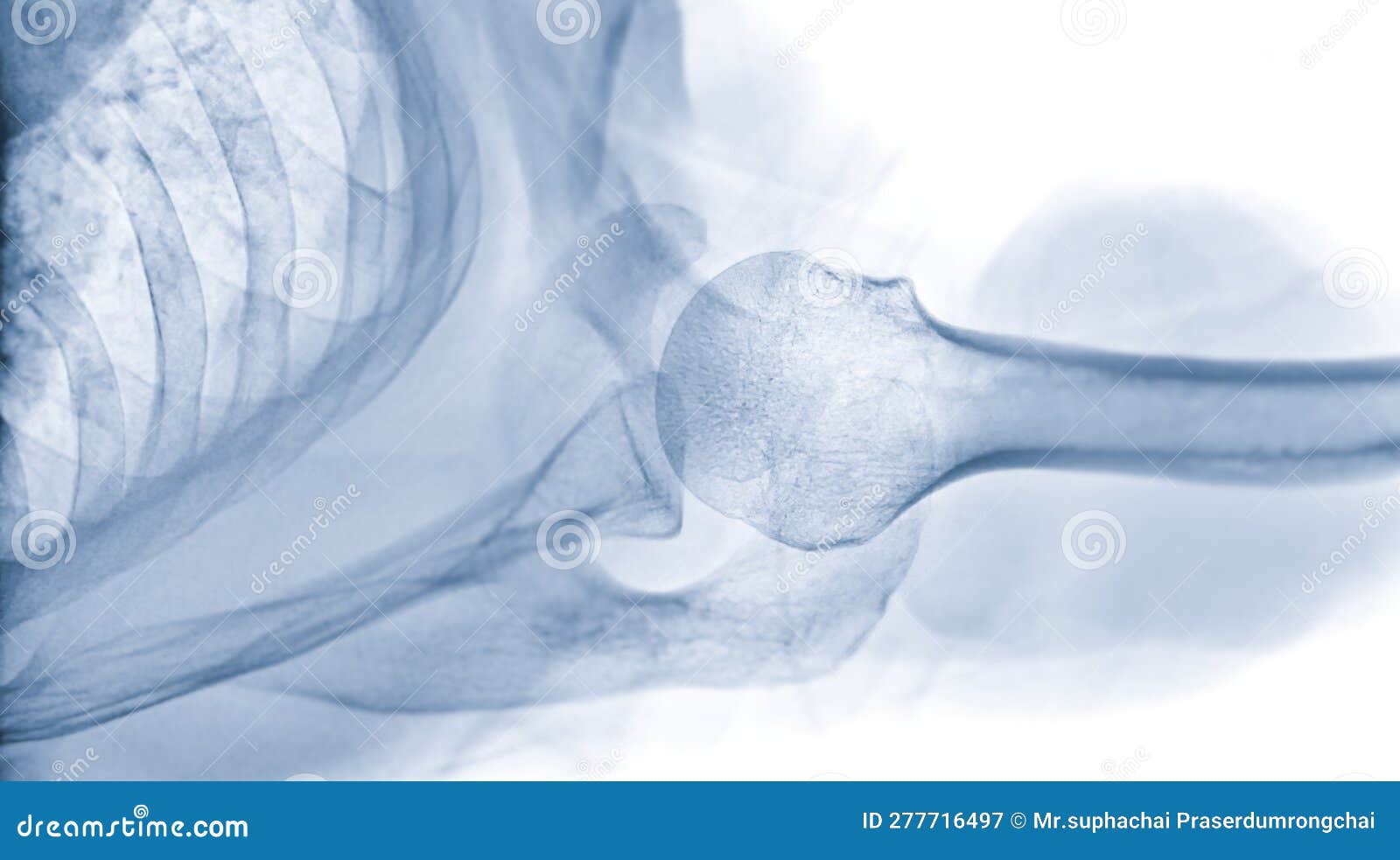 X-ray Shoulder Joint Shoulder Transaxillary View for Diagnosis Fracture ...