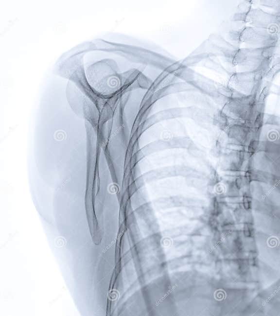 X-ray of Shoulder Joint Transcapula View Showing Normal Scapula Bone ...