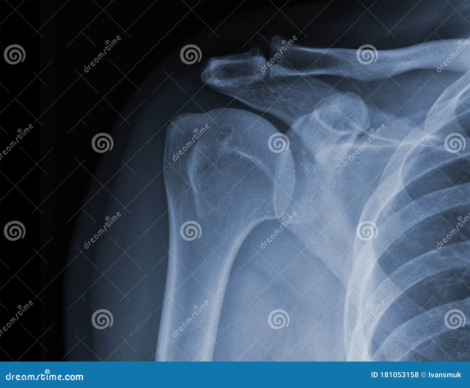 X-ray shoulder radiograph stock photo. Image of body - 181053158