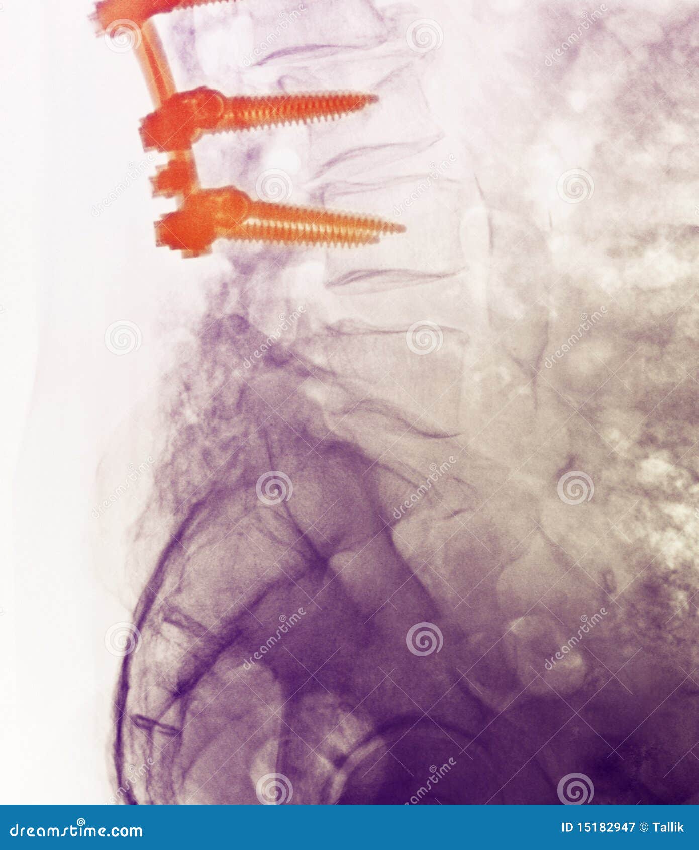 Dog X Ray Showing Spinal Column Fracture In A Dog. Lumbar Spine ...