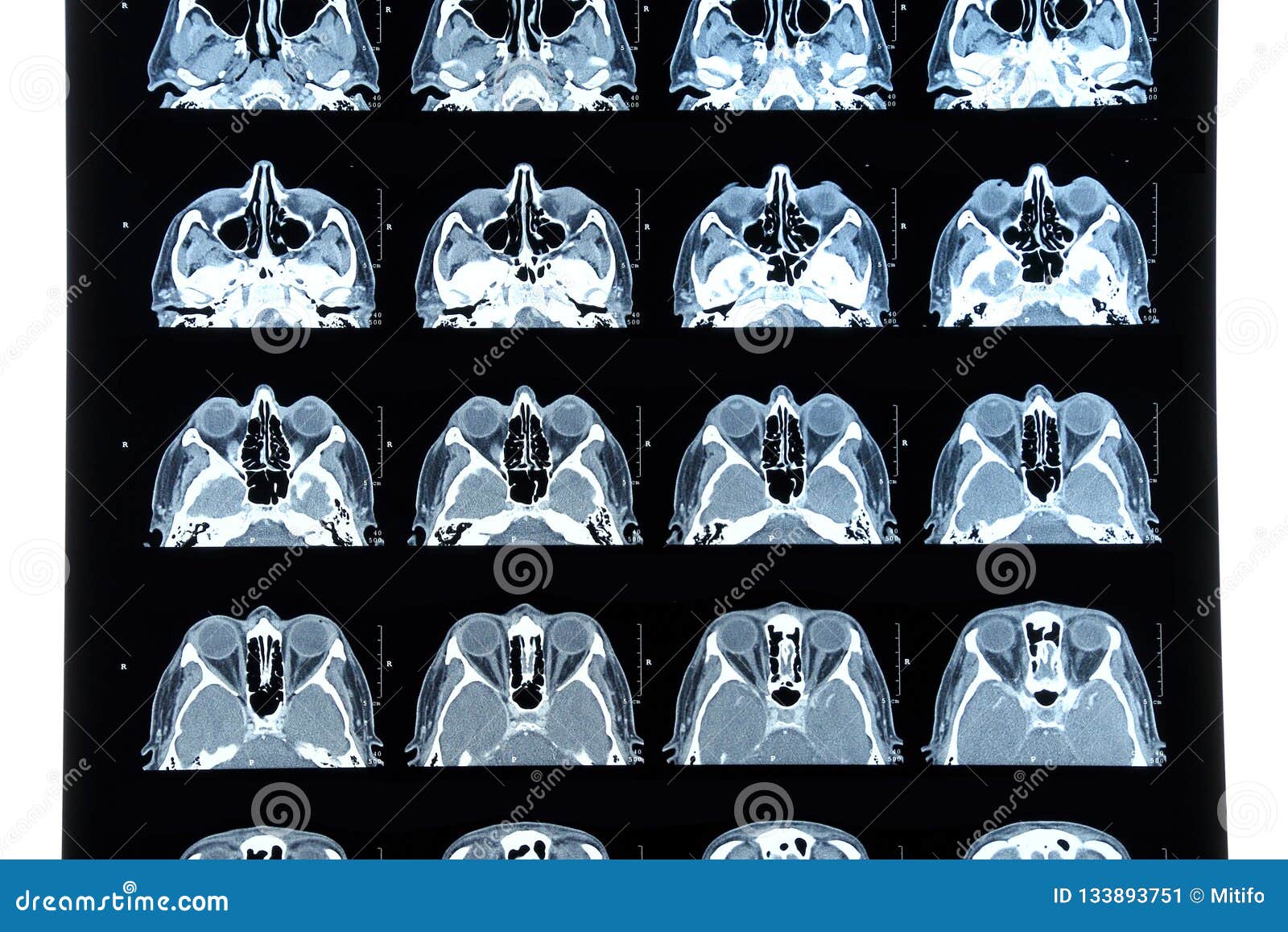 X-ray, Slice, CT of the Head Stock Image - Image of pain, kopf: 133893751