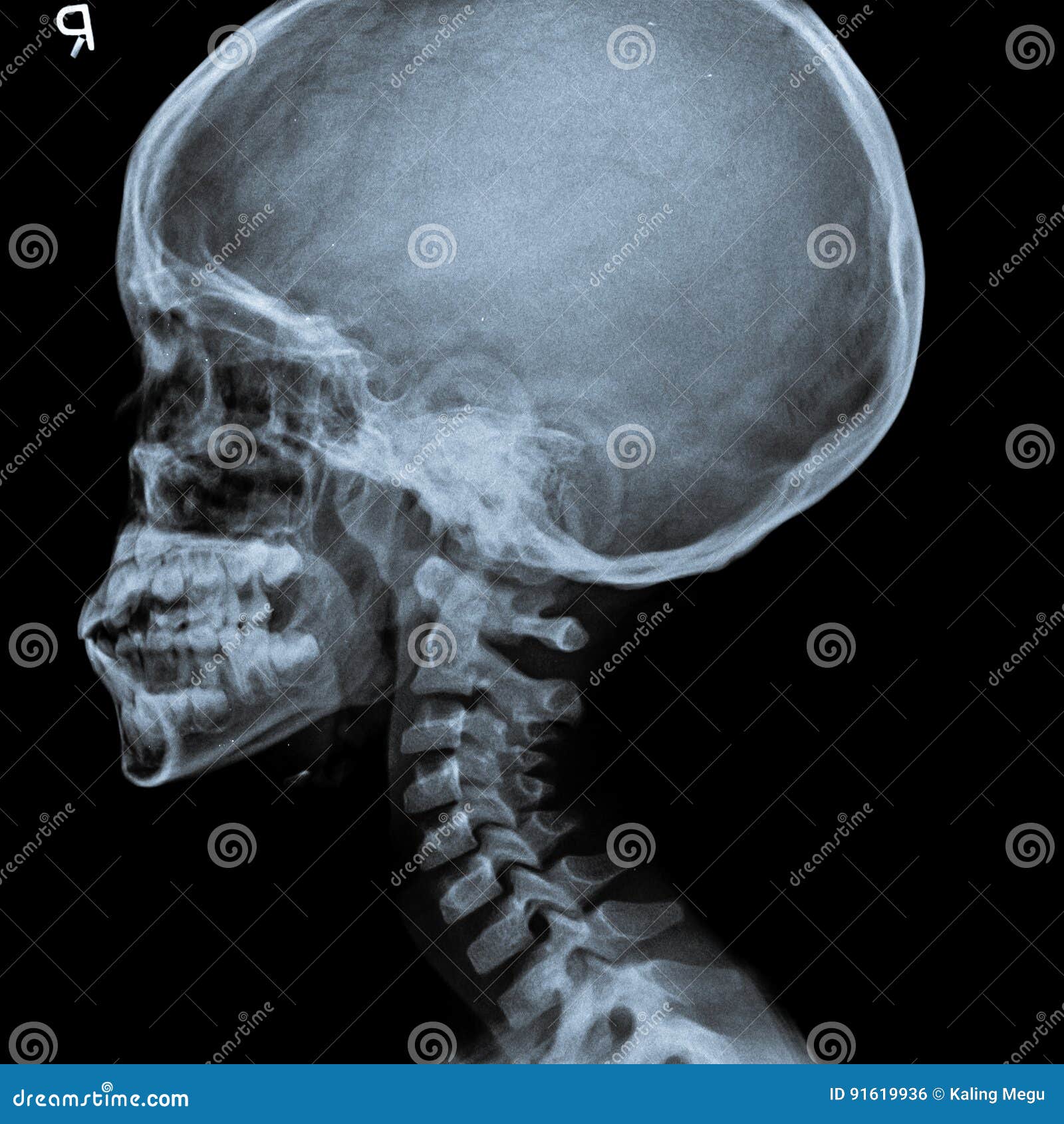 X Ray Of Side View Of Human Child Skull. Stock Photography ...