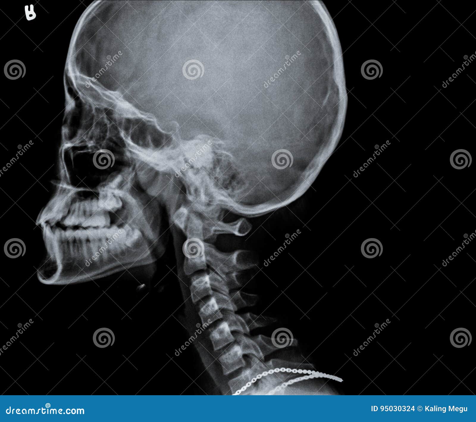 X Ray Skull Side