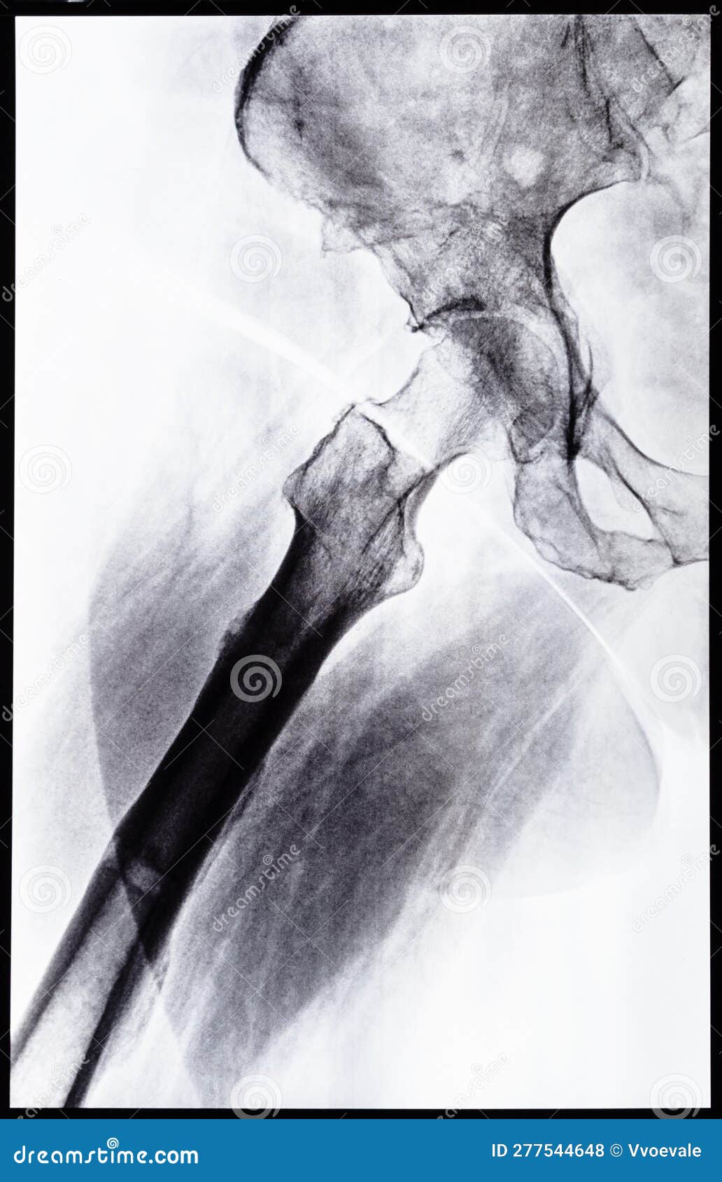 X-ray Side View of Junction of Tibia and Pelvis Stock Illustration ...