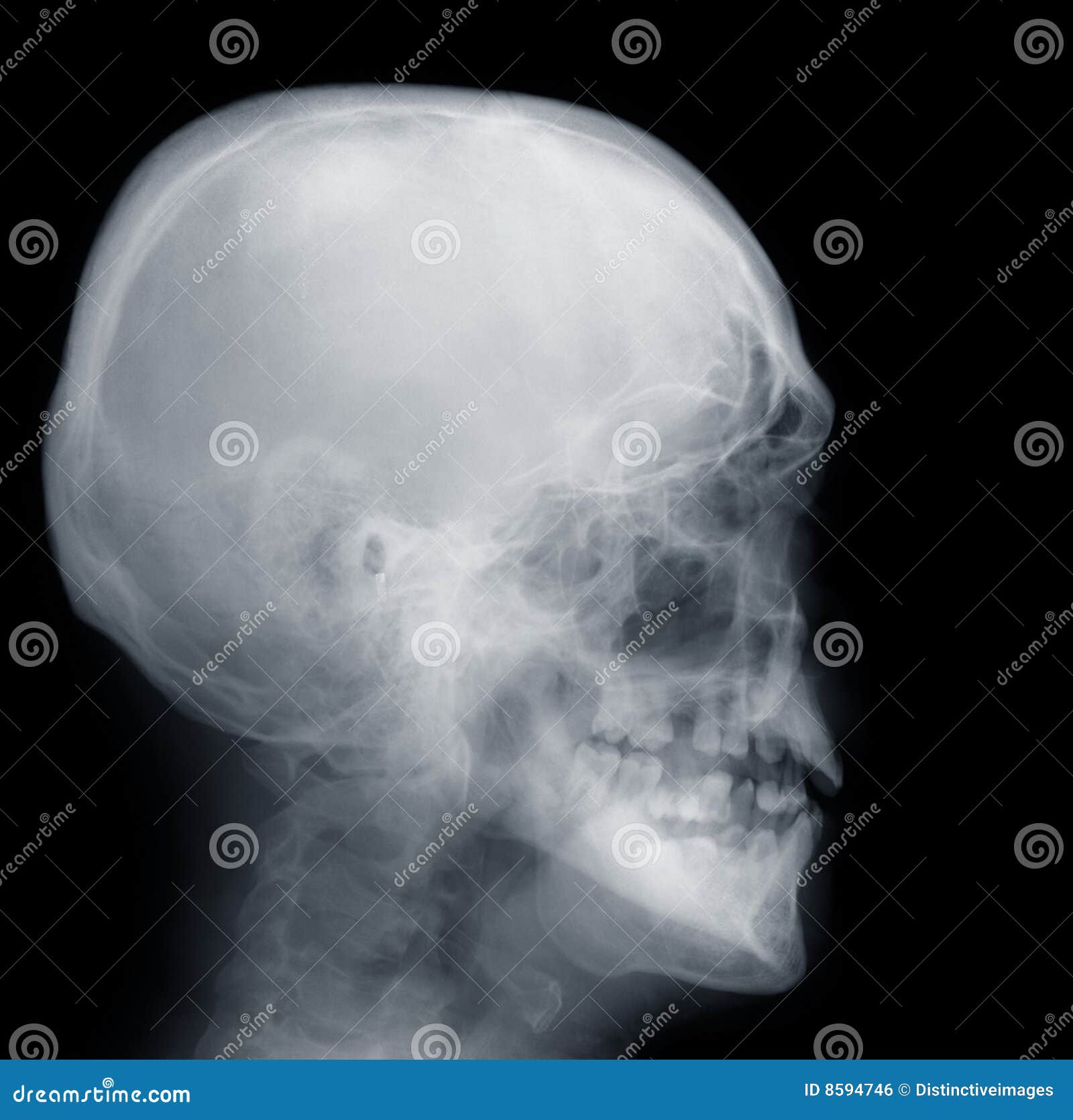 X-ray Skull stock photo. Image of view, exam, bone, side - 8594746