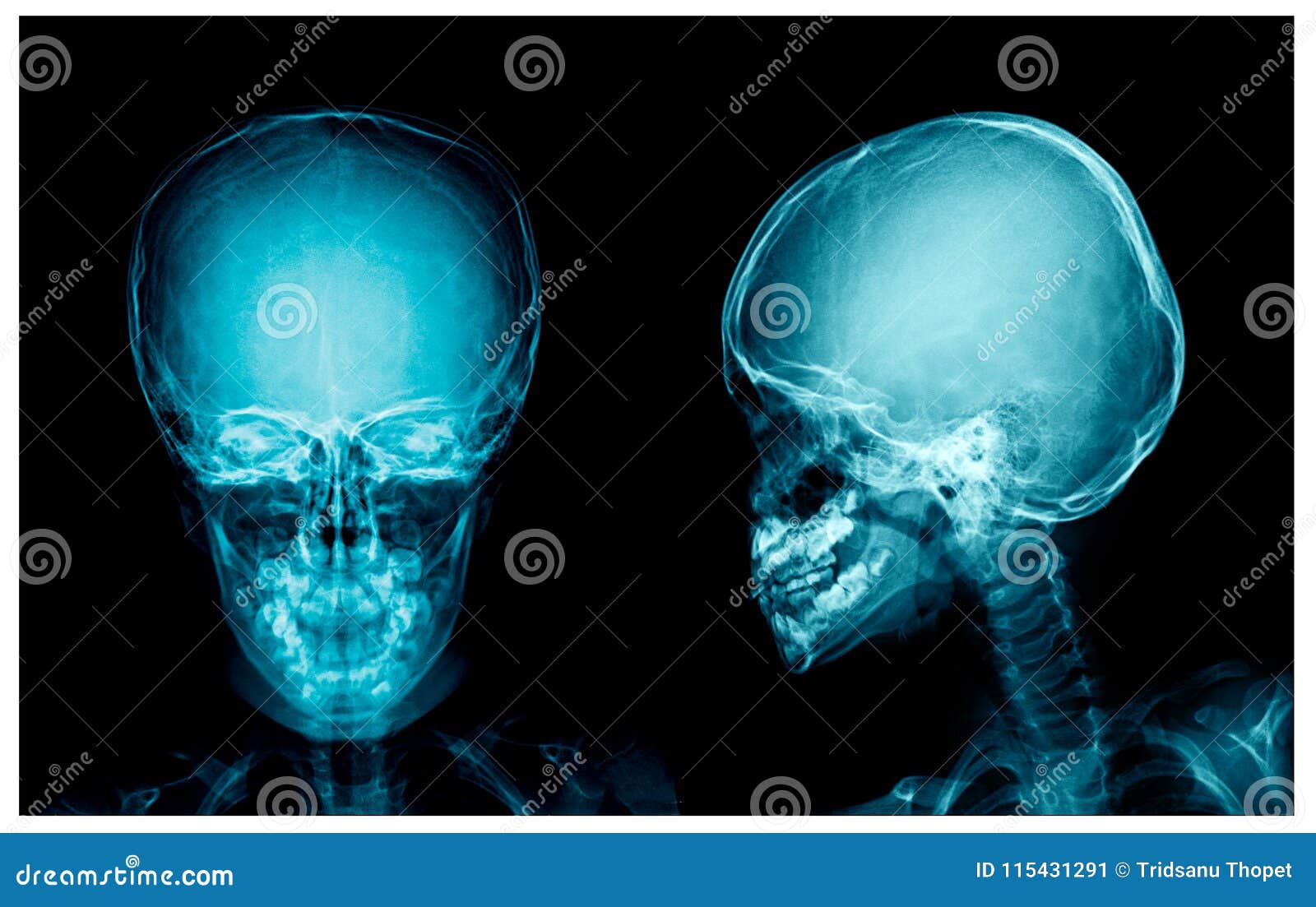 Ap Skull X Ray Ap Skull X Ray