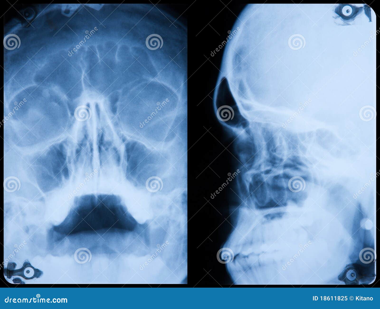 X-Ray Skull Front and Side Profile Stock Image - Image of inside, high ...
