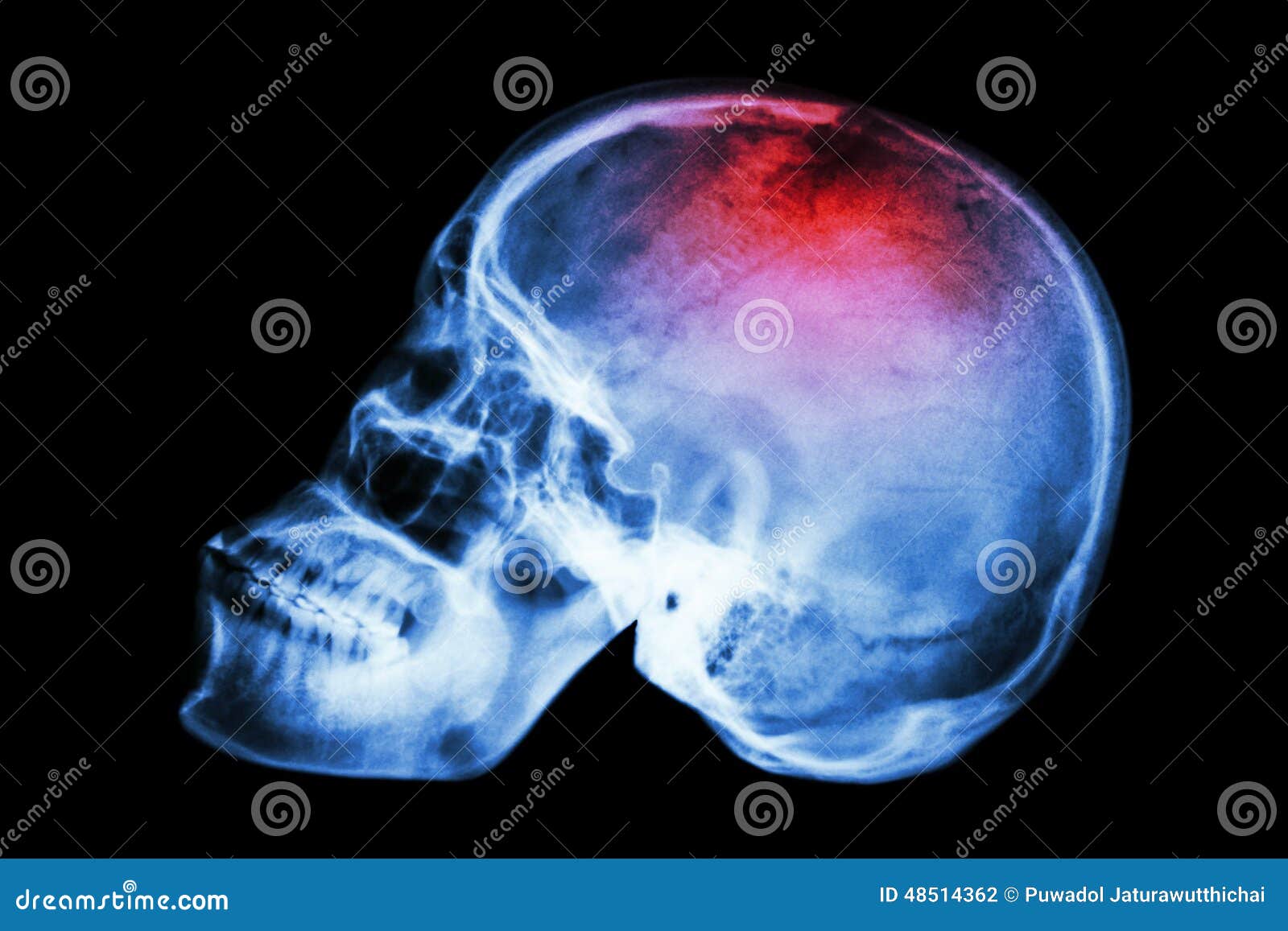 Skull X-ray Lateral View Fusion With MRI Brain Sagittal View. Royalty ...
