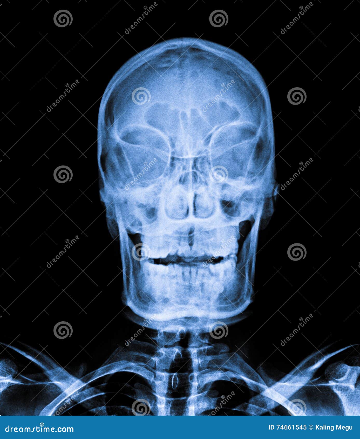 How Evonos is Revolutionizing the Medical World With their Skull Implants