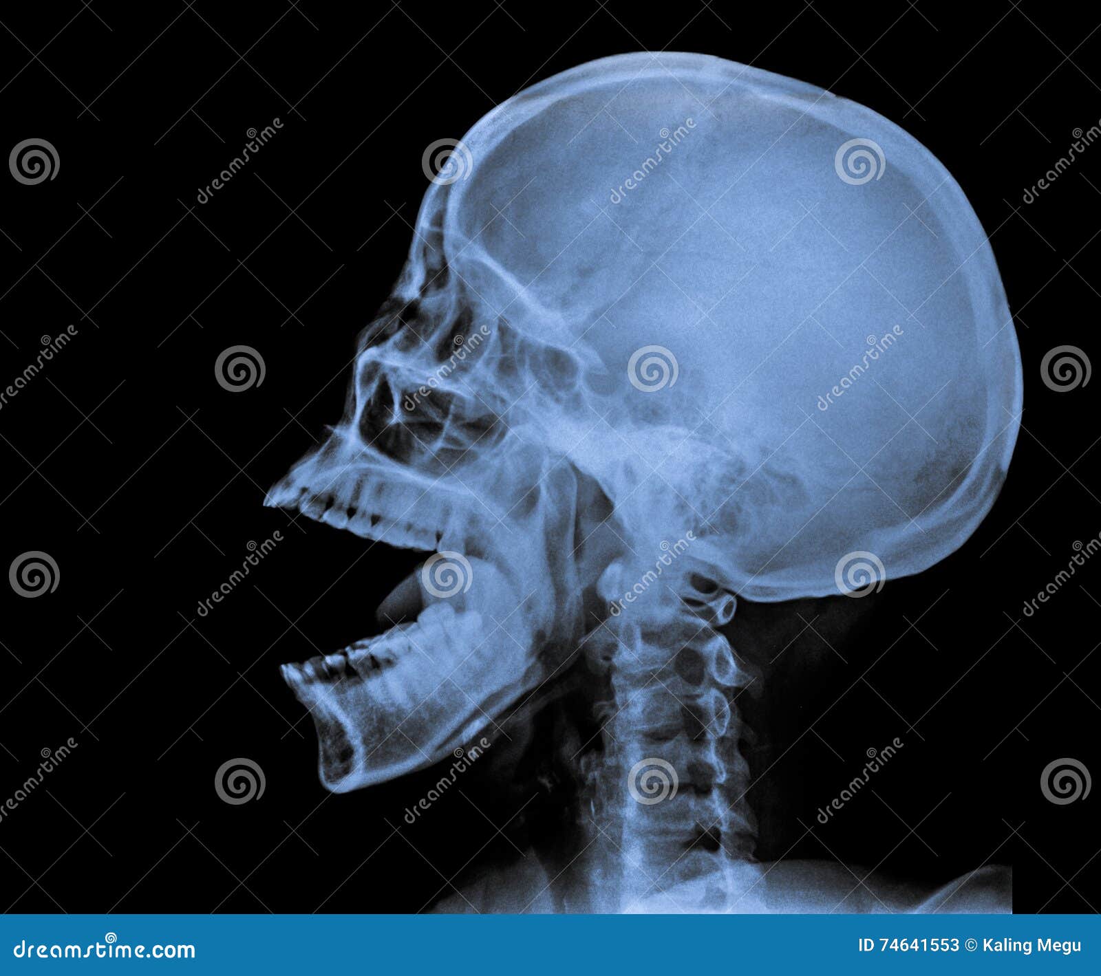 X Ray of Skull. stock image. Image of open, right, bone - 74641553