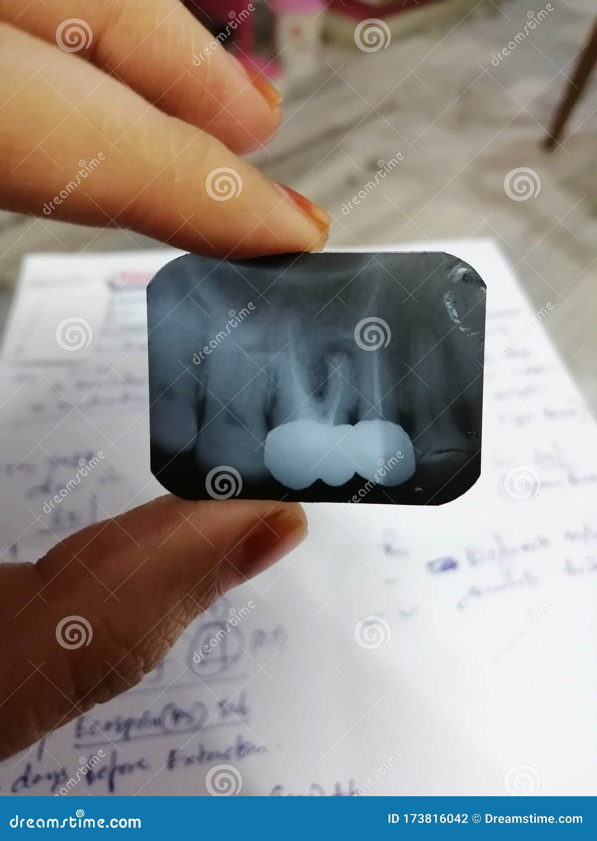 X-ray of teet stock photo. Image of iopa, infected, radiolucent - 173816042