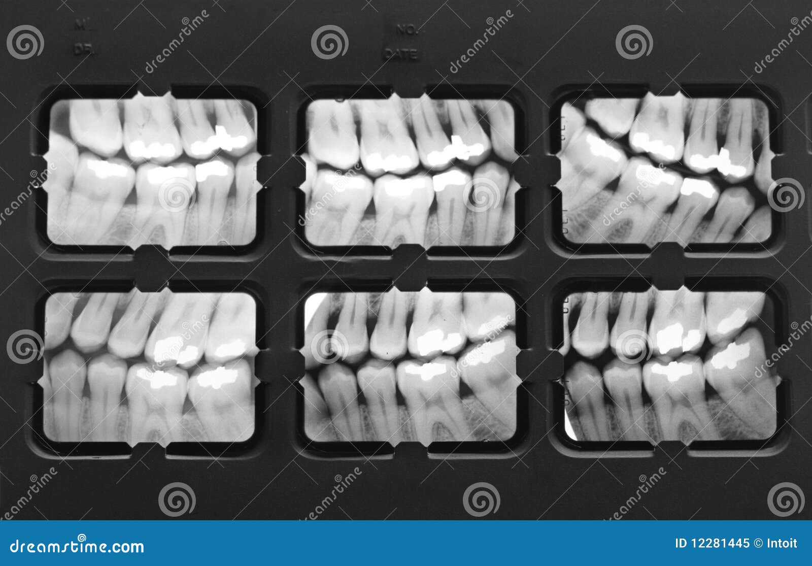 X-Ray of Teeth stock image. Image of mouth, hygene, dental - 12281445