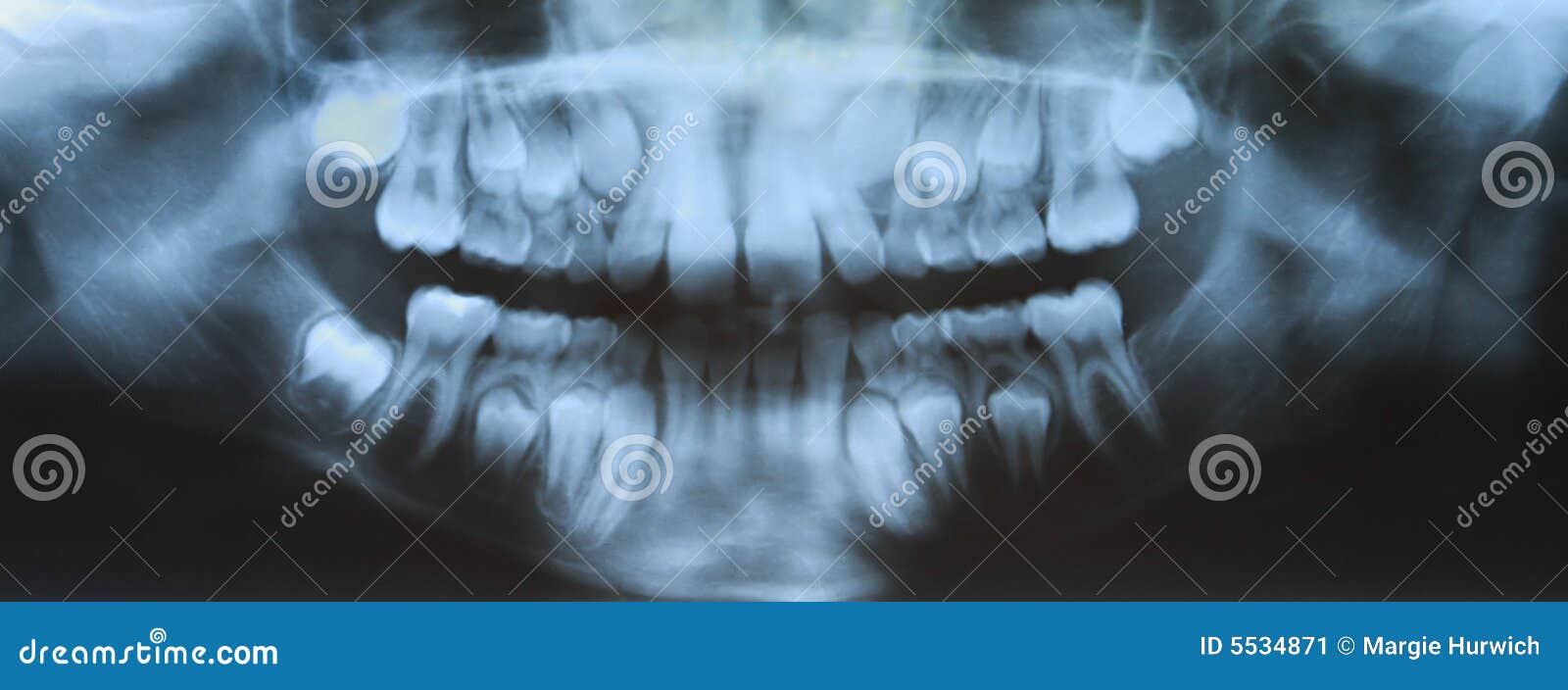 X-ray of teeth stock image. Image of teeth, bicuspid, medical - 5534871