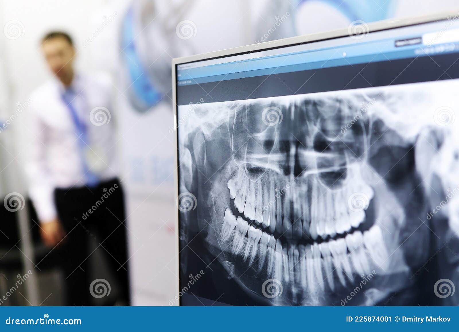 X-ray of Teeth on a Computer Monitor. Scanning the Human Jaw for ...