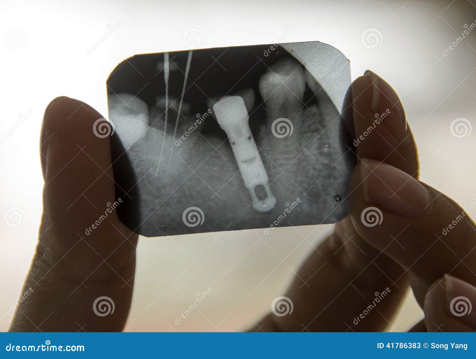 X-ray teeth diagnostics stock image. Image of dentistry - 41786383