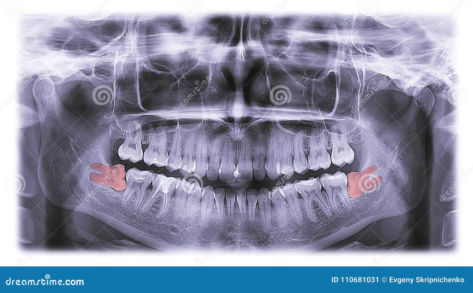 X-ray of Teeth, Molar Tooth Improperly Growing Stock Image - Image of ...