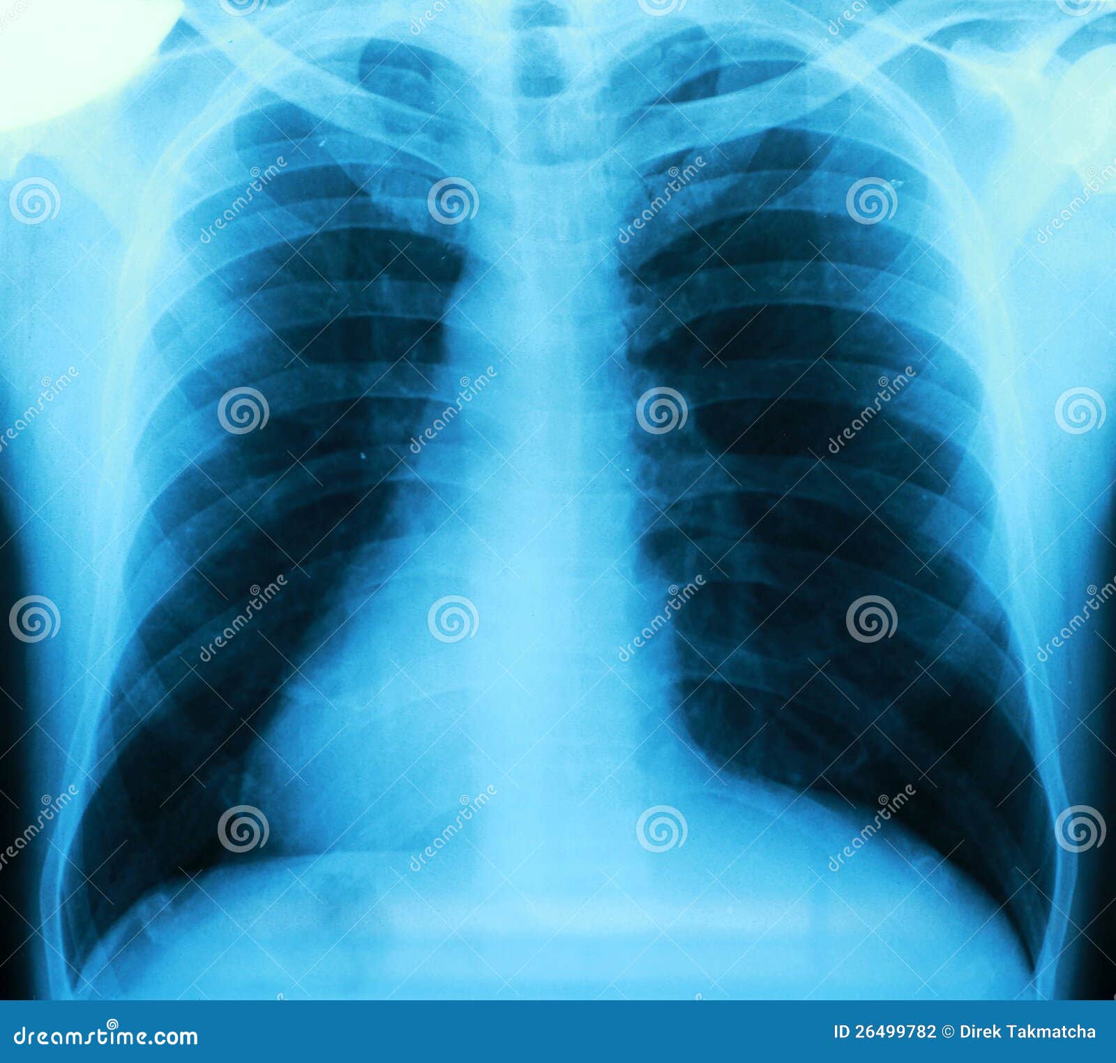 X-ray of a thorax stock photo. Image of brown, roentgen - 26499782
