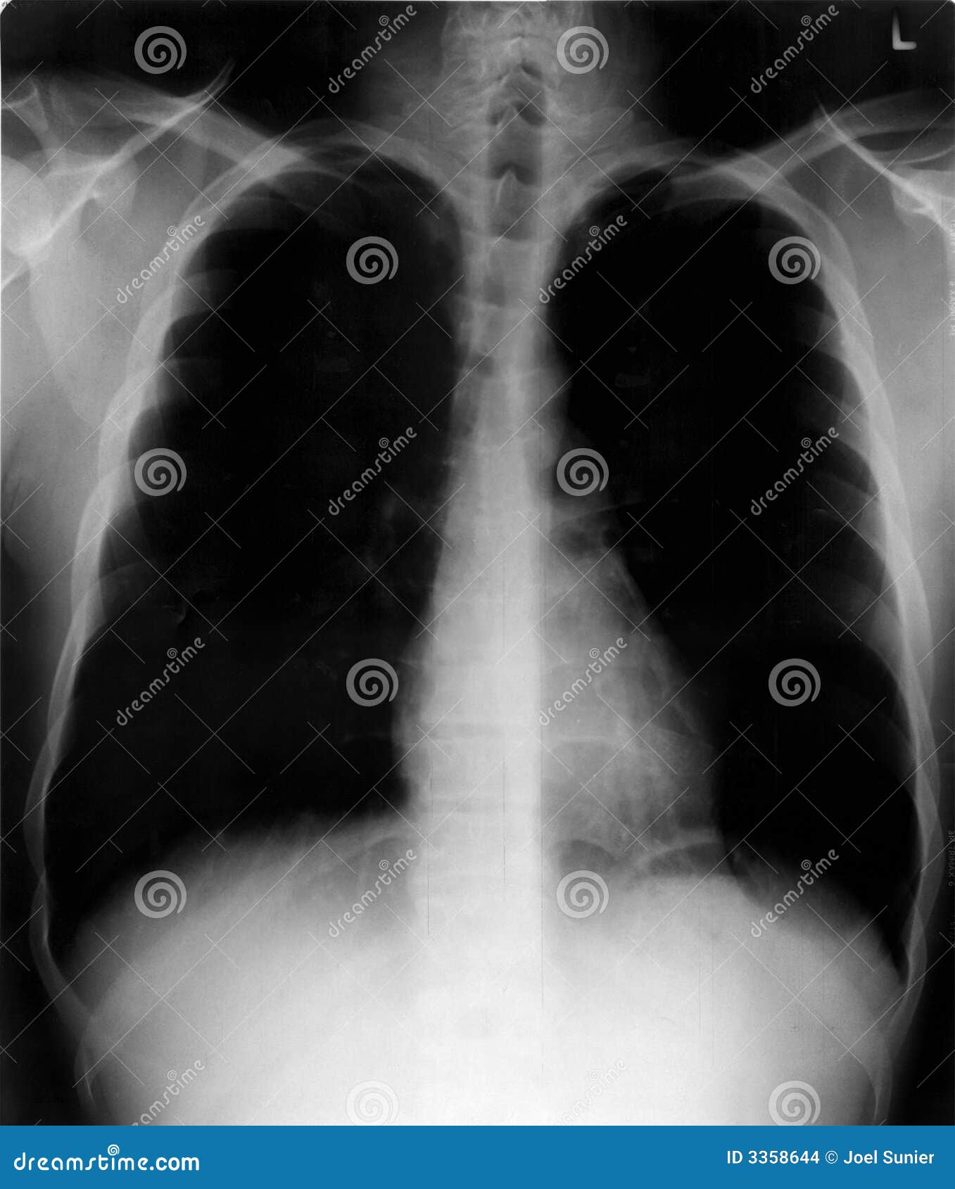 X-ray thorax stock photo. Image of white, column, cloth - 3358644