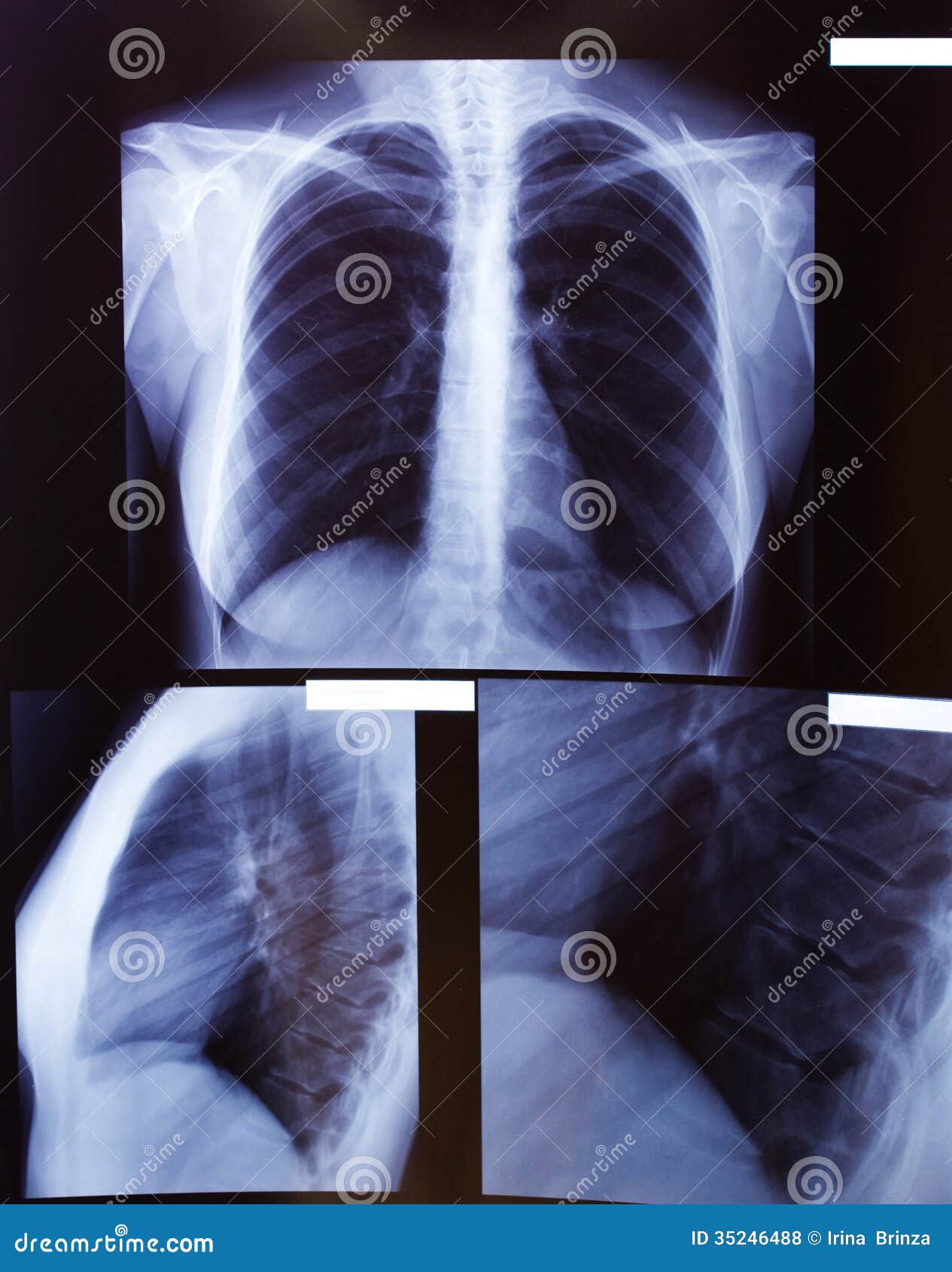 X-ray of a thorax stock photo. Image of medicine, paper - 35246488