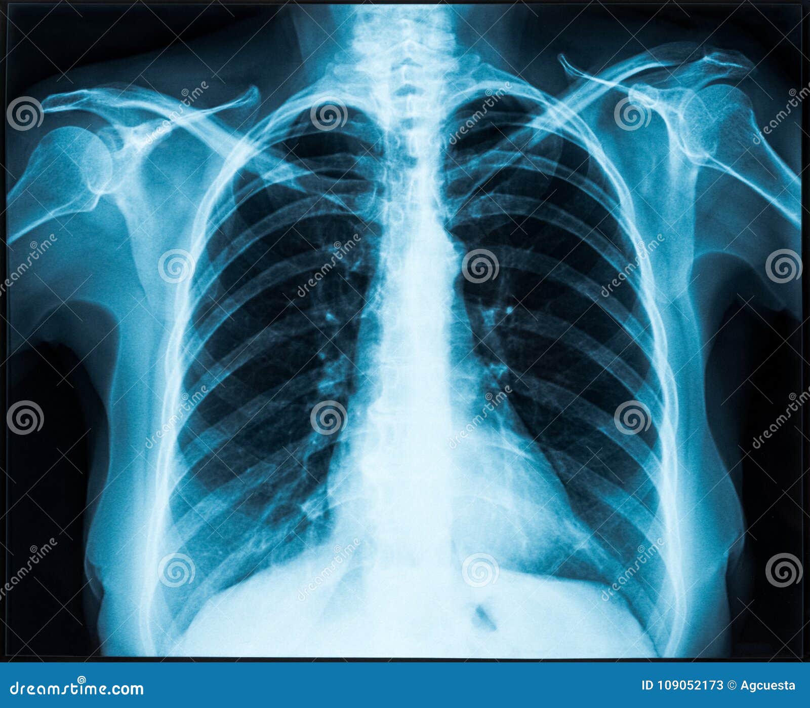 X-ray of thorax stock image. Image of anatomy, examination - 109052173