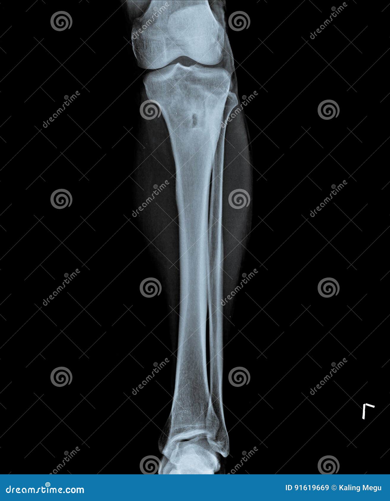 X Ray of Tibia with Infected Wound in Tibia Bone Stock Image - Image of ...