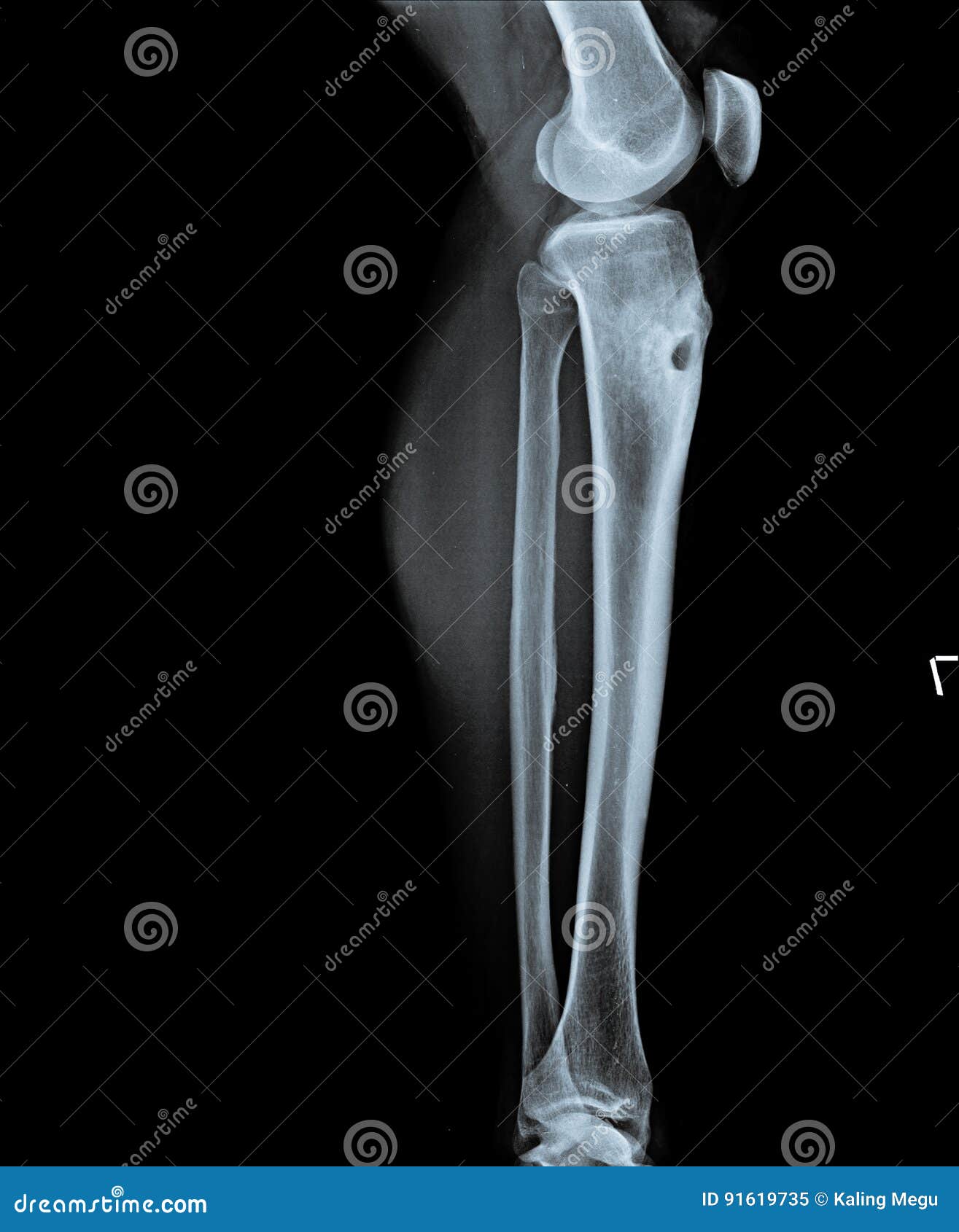 X Ray of Tibia with Infected Wound in Tibia Bone Stock Image - Image of ...