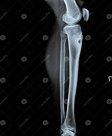 X Ray of Tibia with Infected Wound in Tibia Bone Stock Image - Image of ...