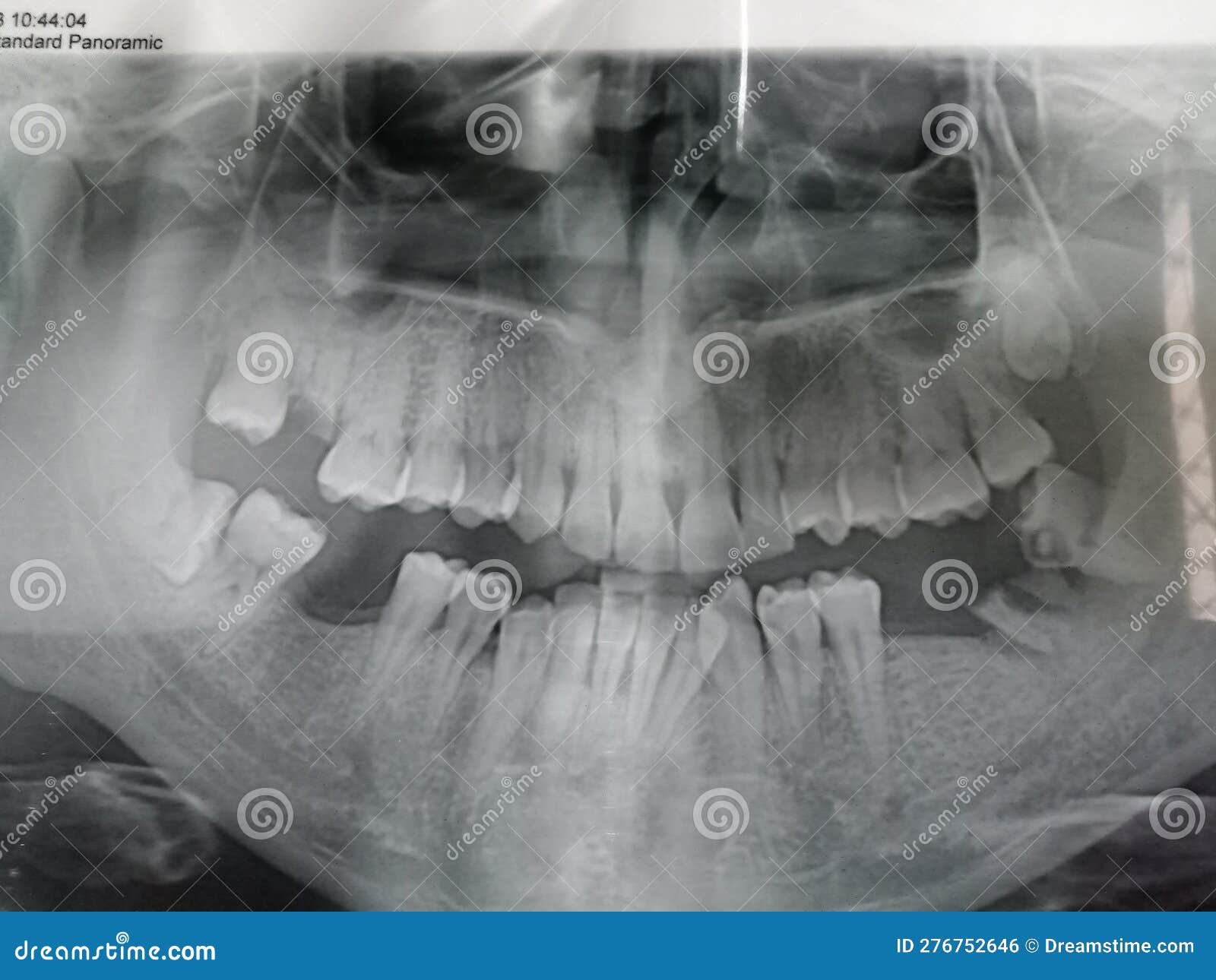 X Ray To See the Teeth in the Mouth Stock Photo - Image of teeth, mouth ...