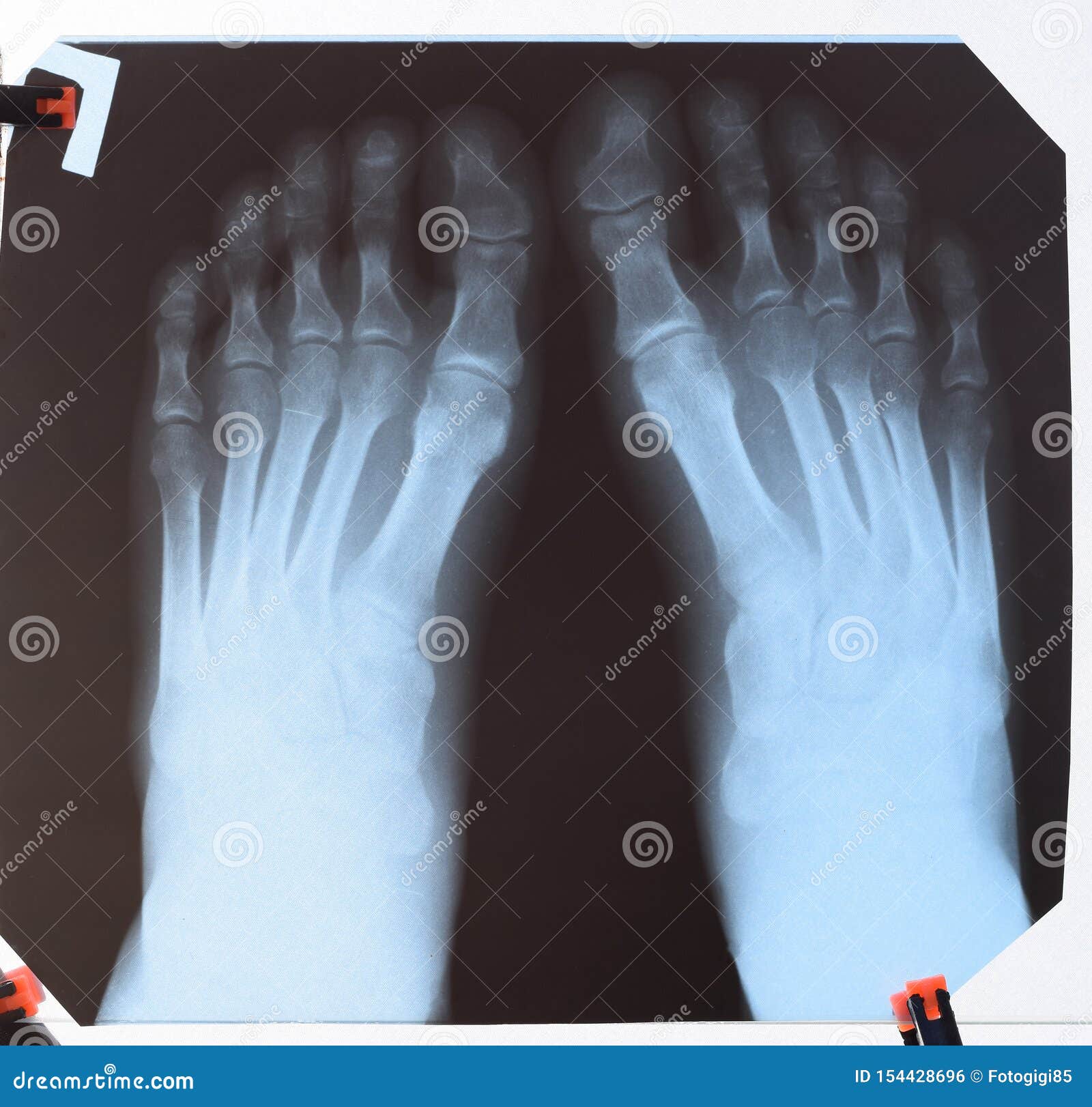 X-ray of Toes. Foot on Xray. Bone Research Stock Photo - Image of ...