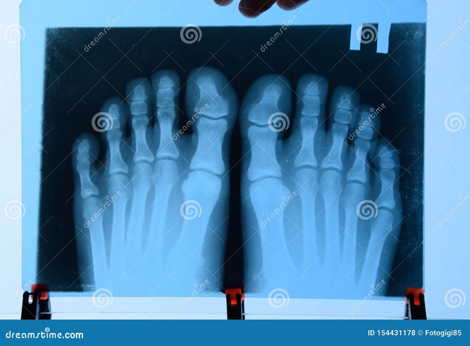 X-ray of Toes. Foot on Xray. Bone Research Stock Photo - Image of ...