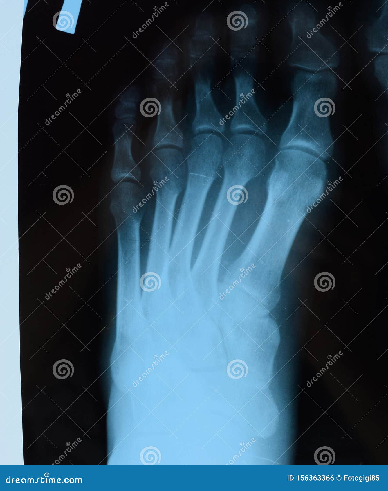 X-ray of Toes. Foot on Xray. Bone Stock Photo - Image of medicine, care ...